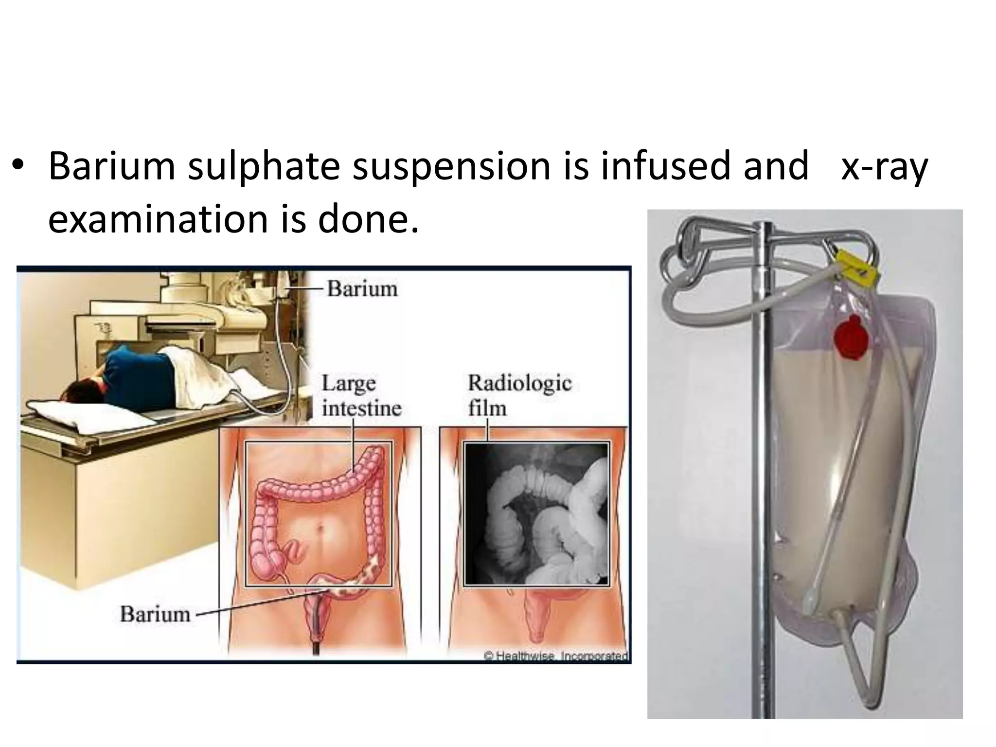 Barium studies | PPTX