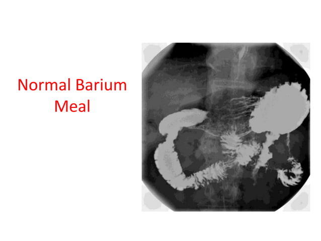 Barium studies | PPTX