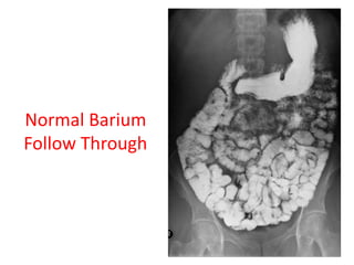 Barium studies | PPTX