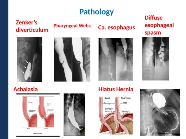 Barium Studies of upper GI Tract by joginder.pptx
