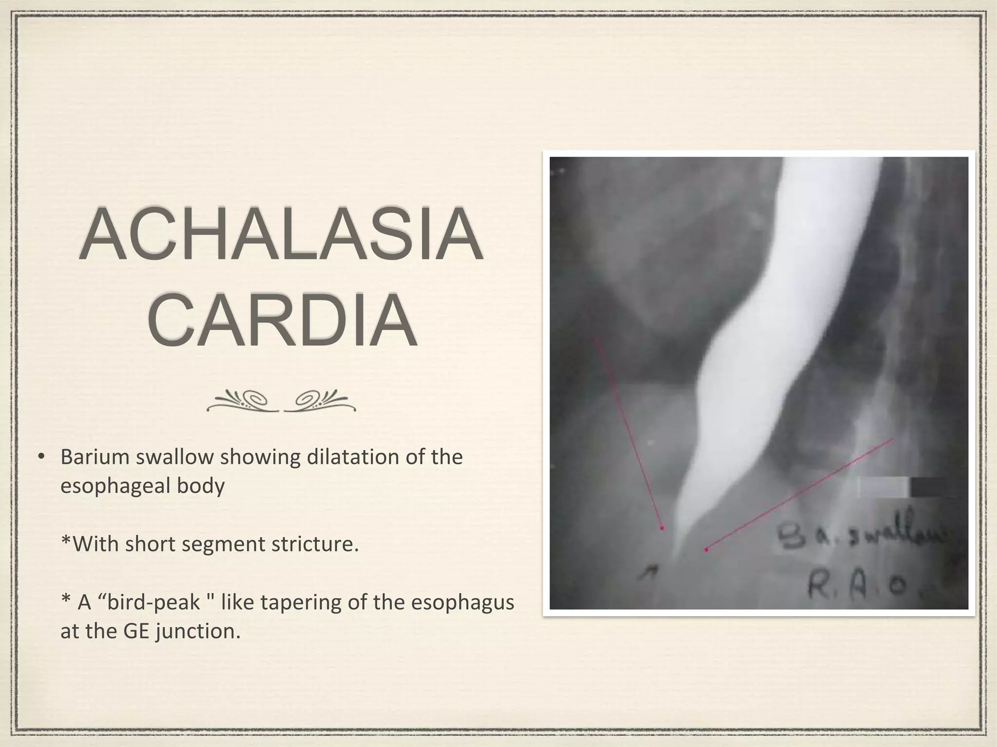 Barium swallow,, | PPTX