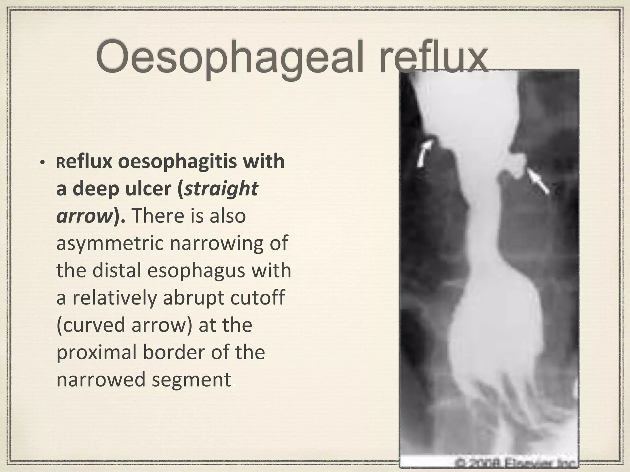 Barium swallow,, | PPTX