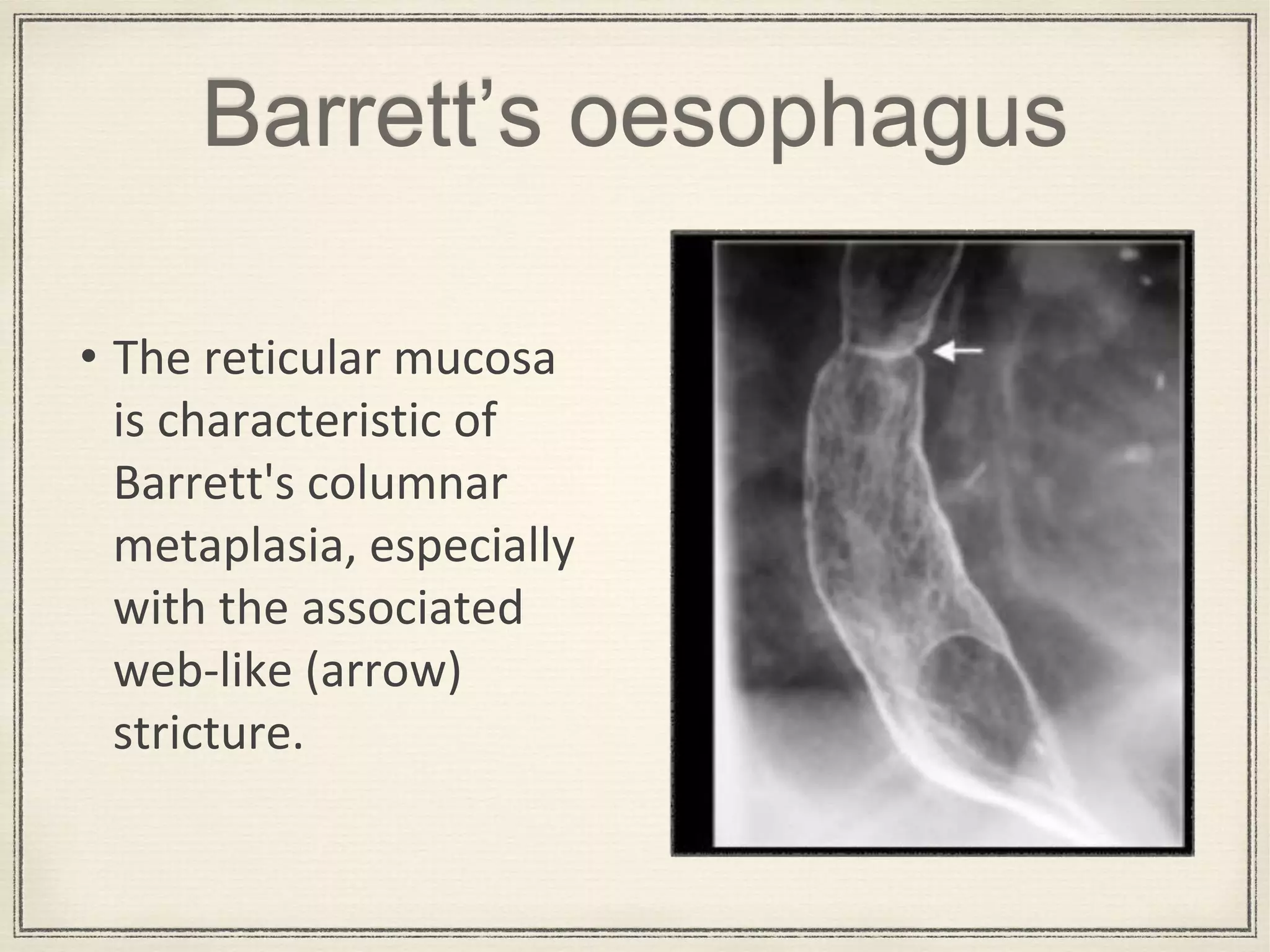Barium swallow,, | PPTX