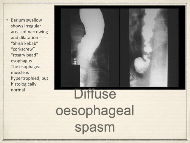 Barium swallow,, | PPTX | Digestive Disorders | Diseases and Conditions