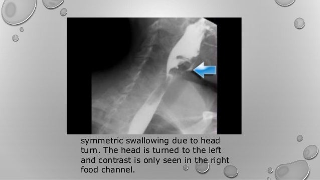 Modified Barium Swallow