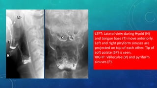 Pyriform Sinus Barium Swallow