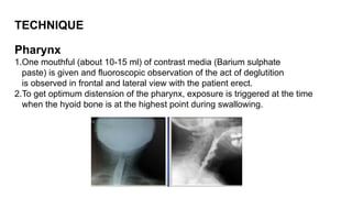 Barium swallow .pdf