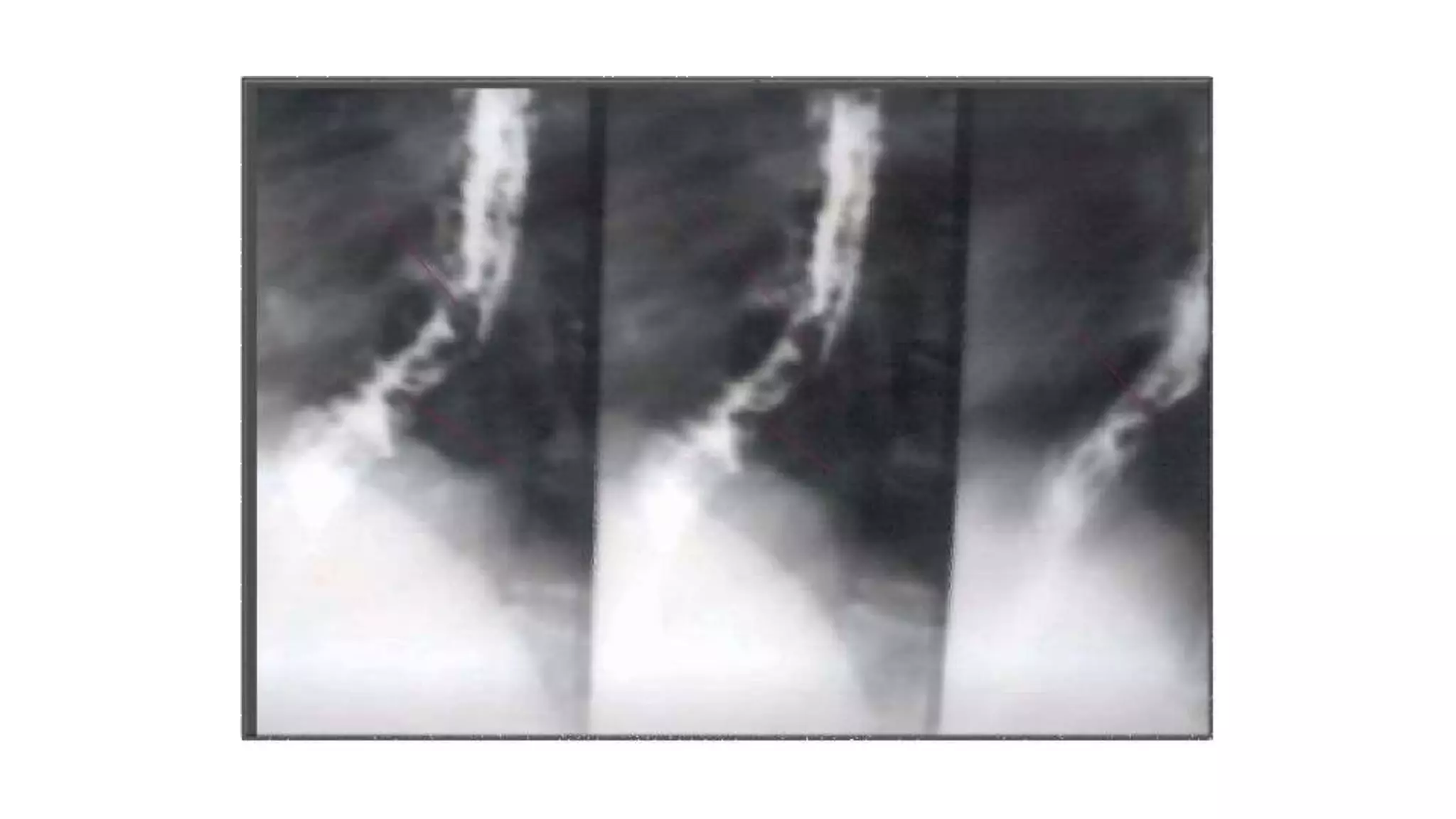 barium swallow.pptx