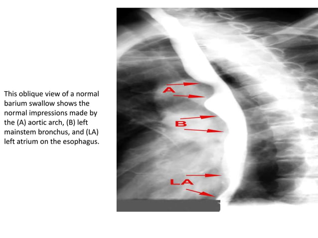 barium swallow.pptx