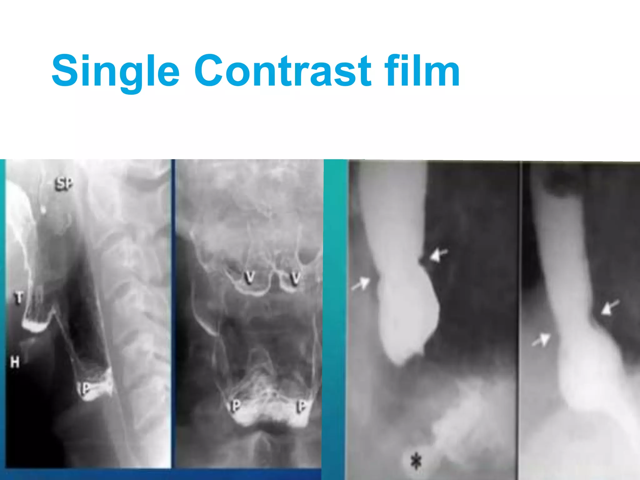 Barium swallow examination | PPTX