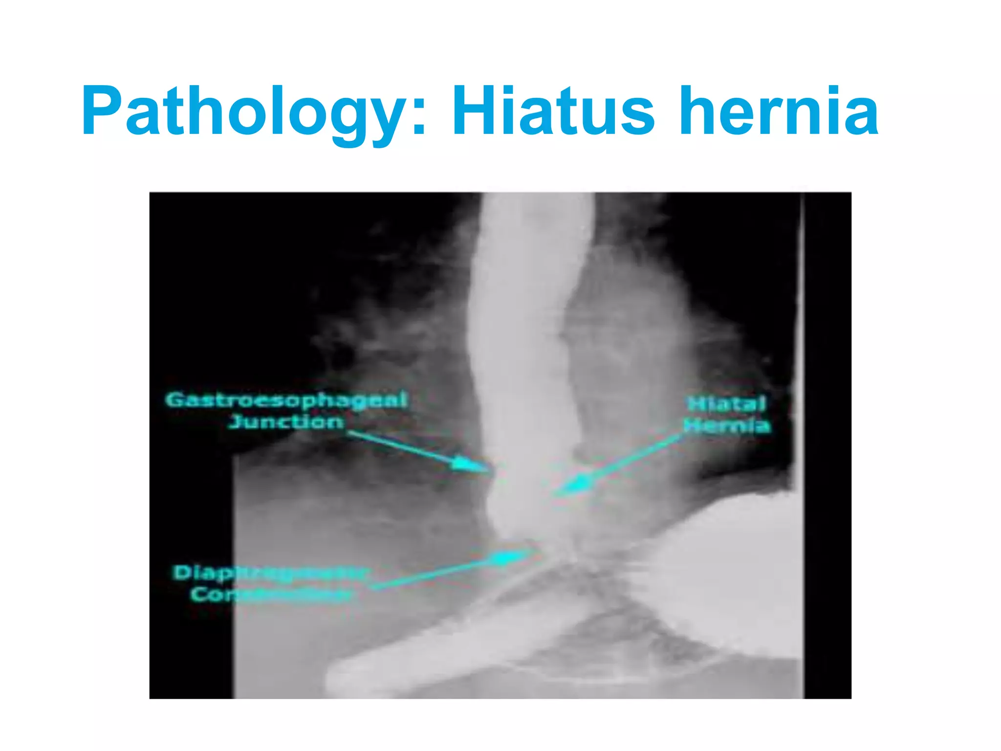 Barium swallow examination | PPTX