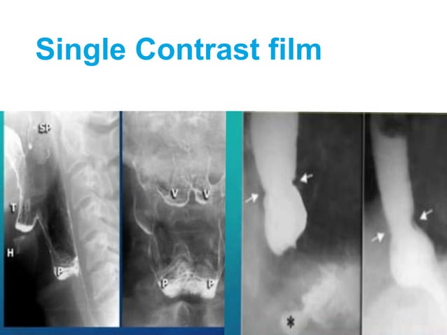 Barium swallow examination | PPTX | Digestive Disorders | Diseases and ...