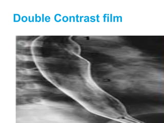 Barium swallow examination | PPTX