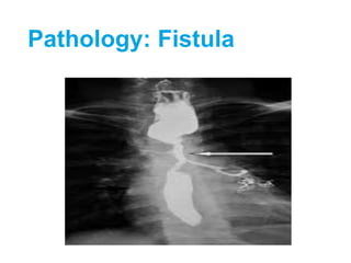 Tracheoesophageal Fistula Barium Swallow
