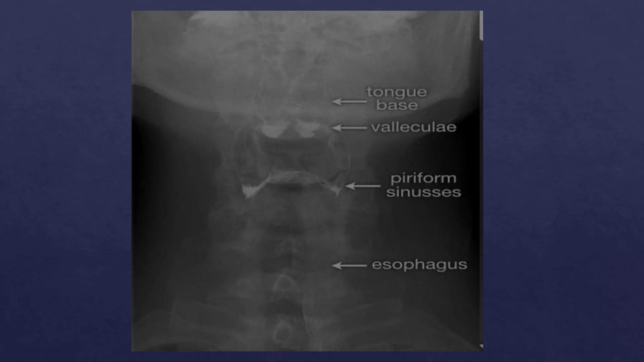 Barium Swallow, Barium Meal & Barium Meal Follow Through.pptx