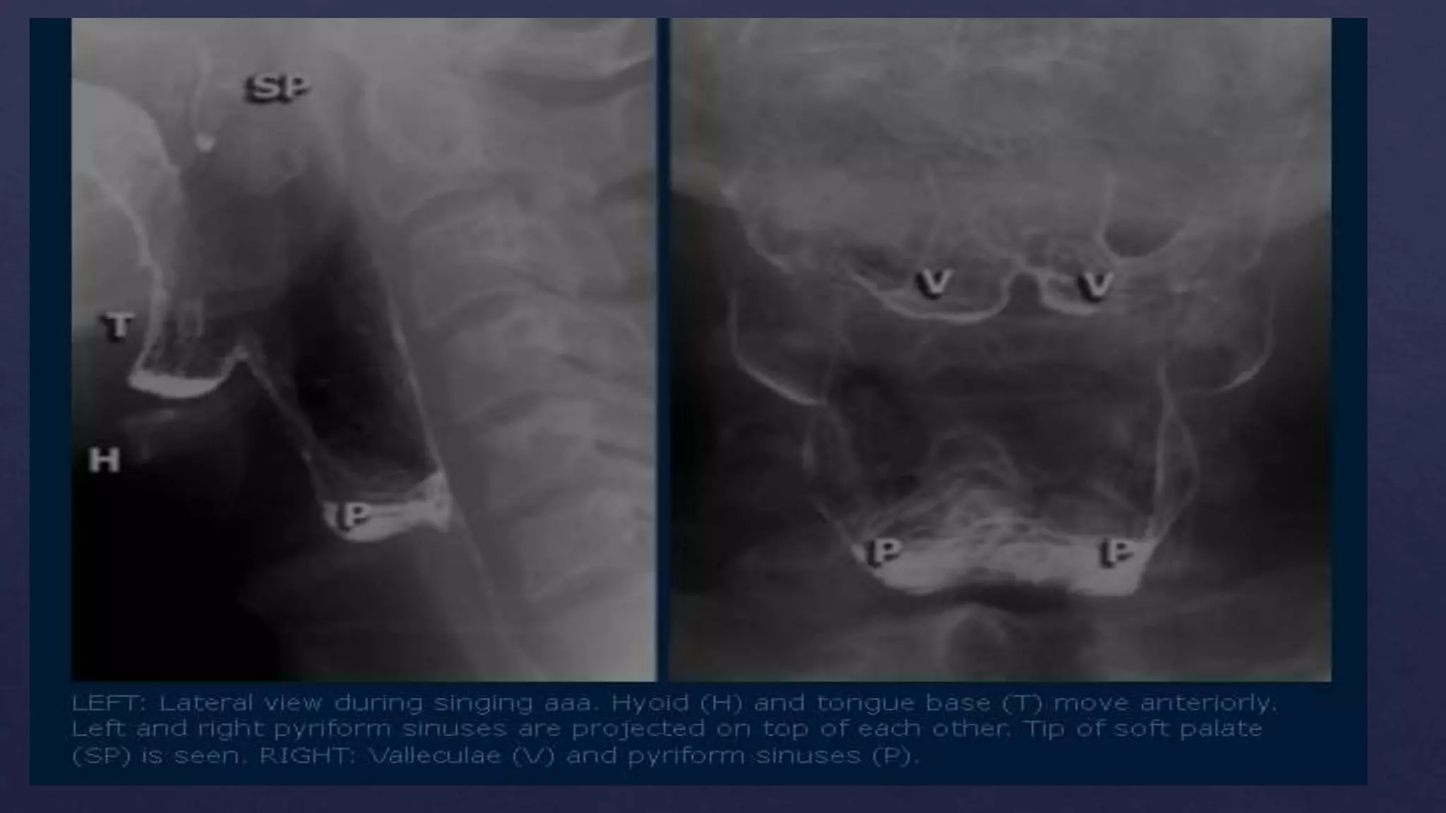 Barium Swallow, Barium Meal & Barium Meal Follow Through.pptx
