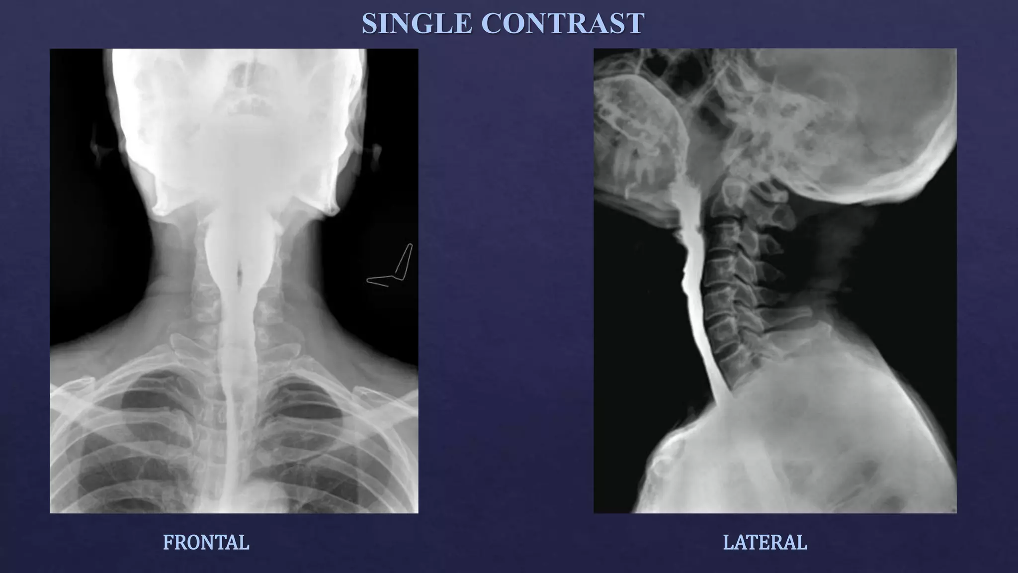 Barium Swallow, Barium Meal & Barium Meal Follow Through.pptx