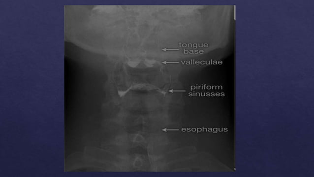 Barium Swallow, Barium Meal & Barium Meal Follow Through.pptx