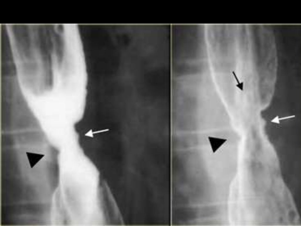 Barium swallow diseases