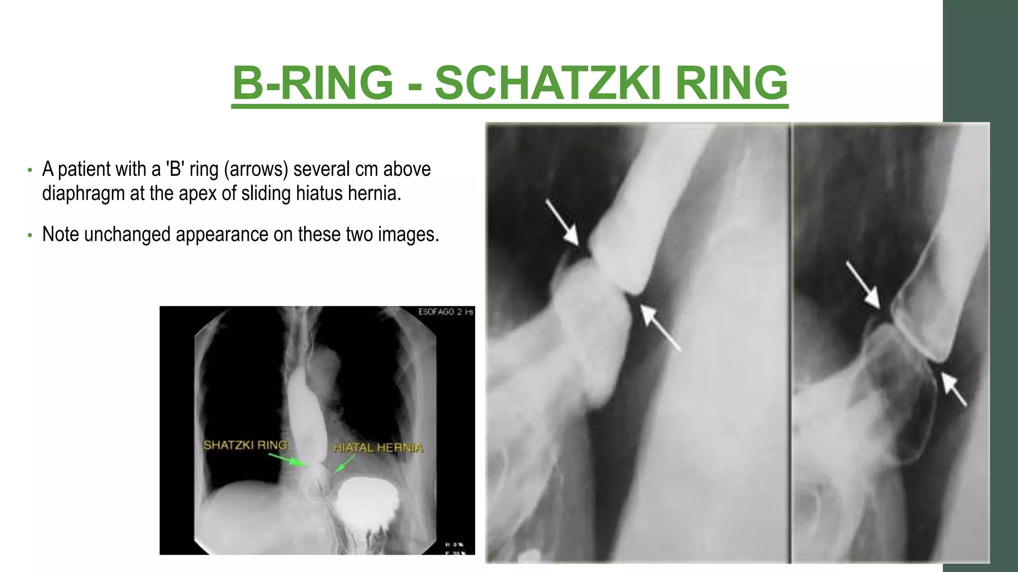 barium swallow EDIT.pptx