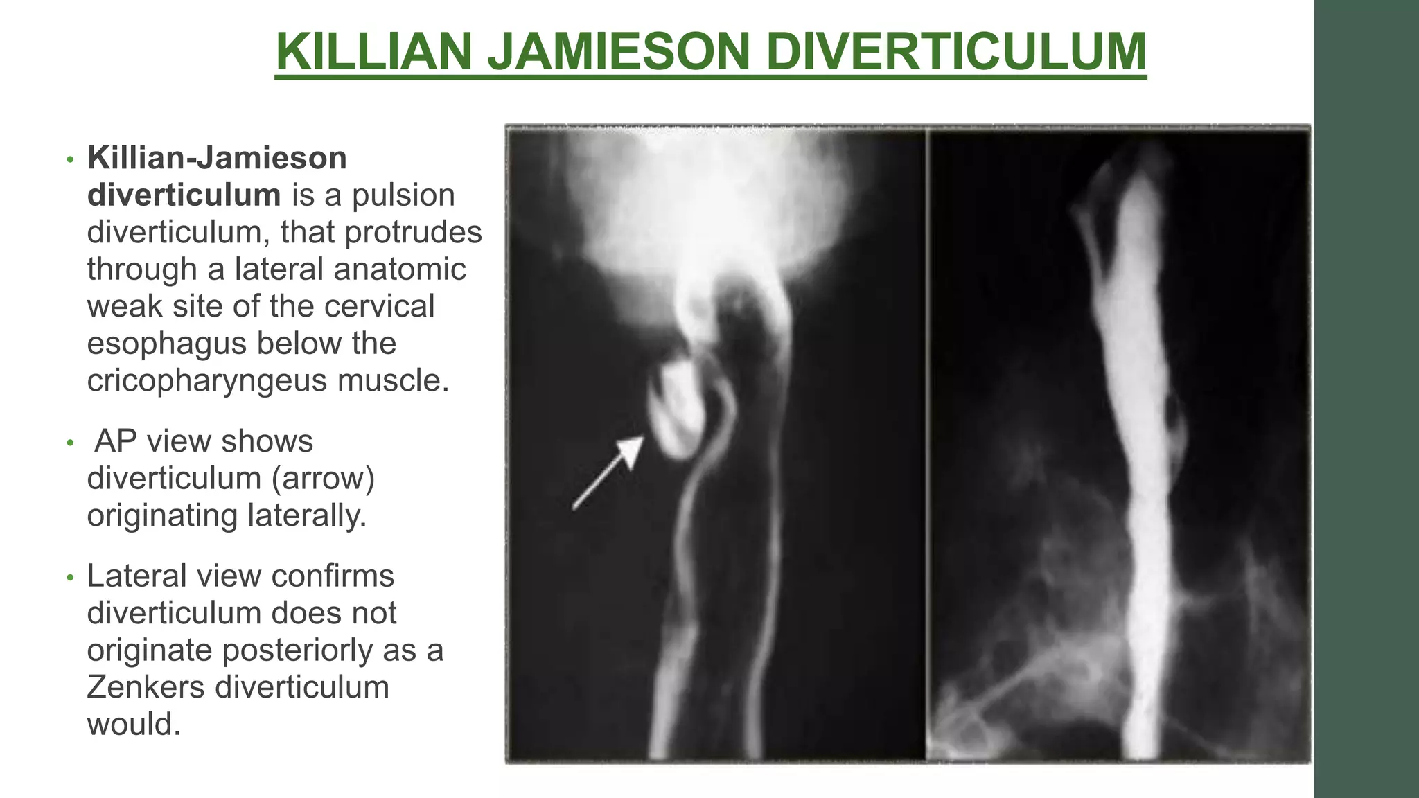 barium swallow EDIT.pptx