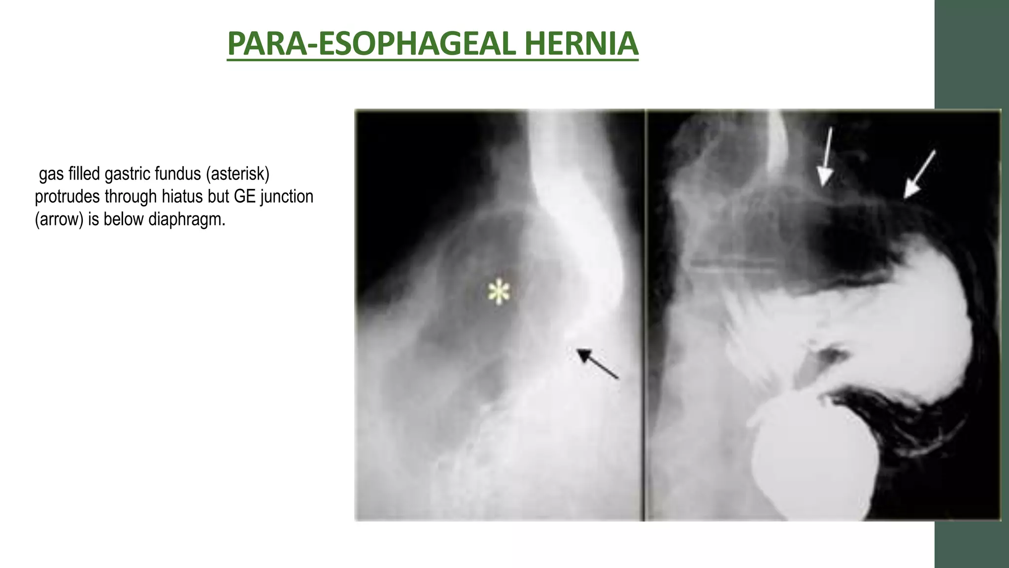 barium swallow EDIT.pptx