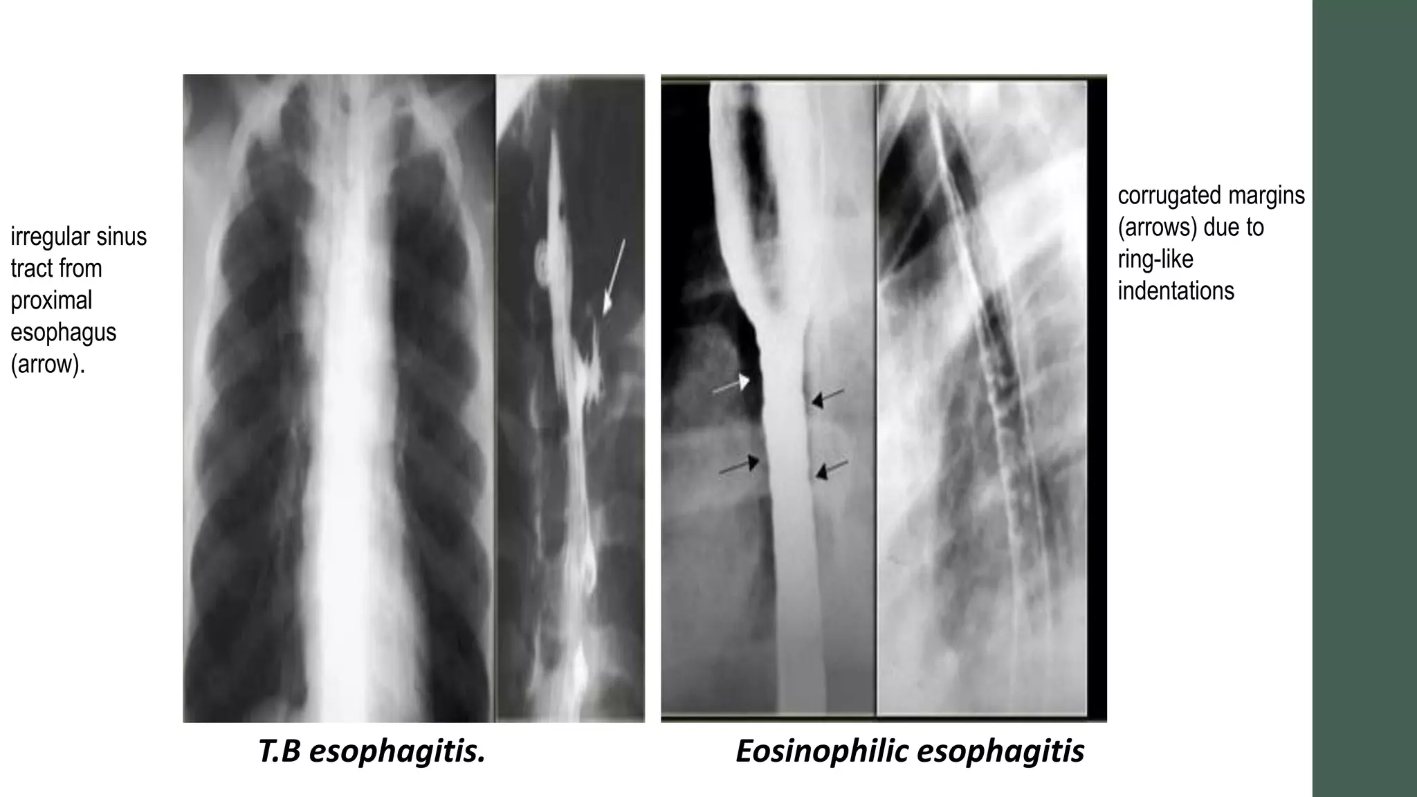 barium swallow EDIT.pptx