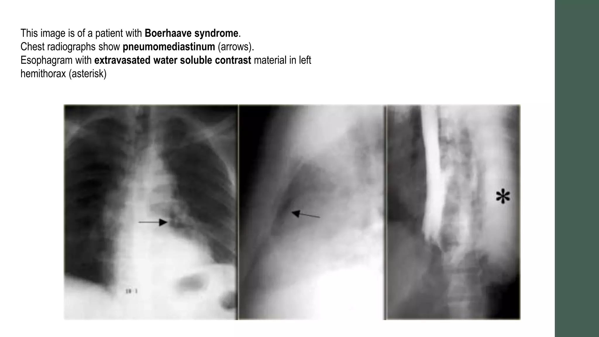 barium swallow EDIT.pptx