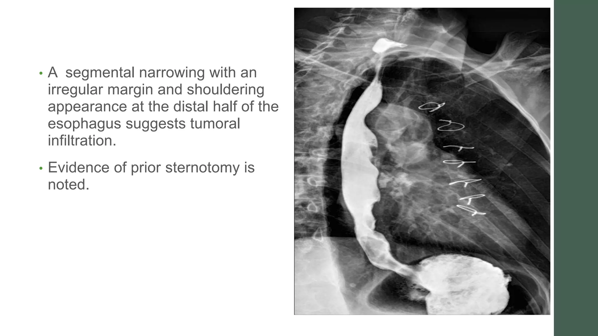 barium swallow EDIT.pptx
