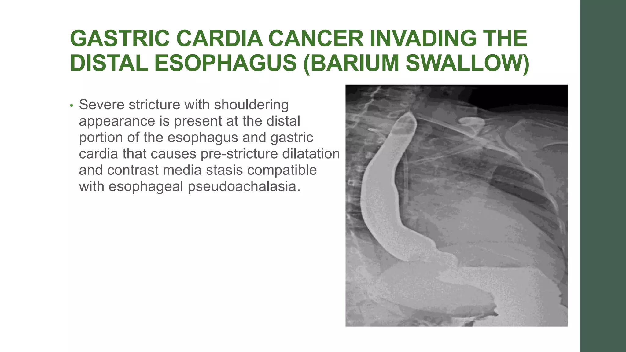 barium swallow EDIT.pptx