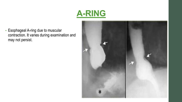 barium swallow EDIT.pptx