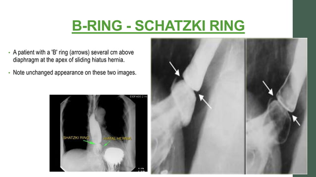 barium swallow EDIT.pptx