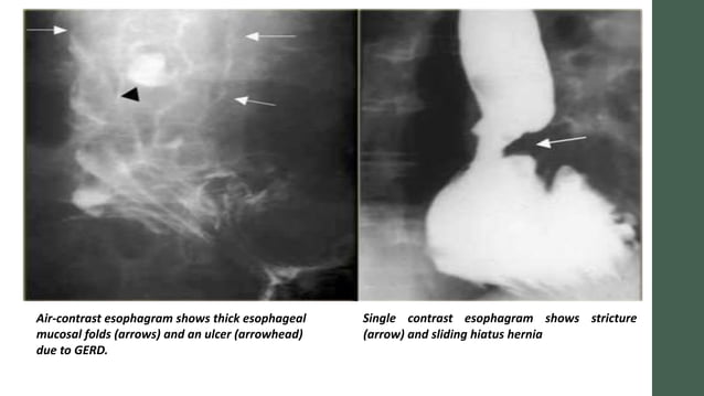 barium swallow EDIT.pptx