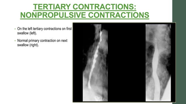 barium swallow EDIT.pptx