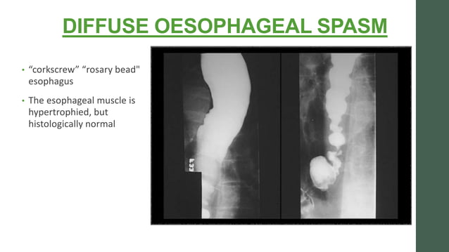 barium swallow EDIT.pptx