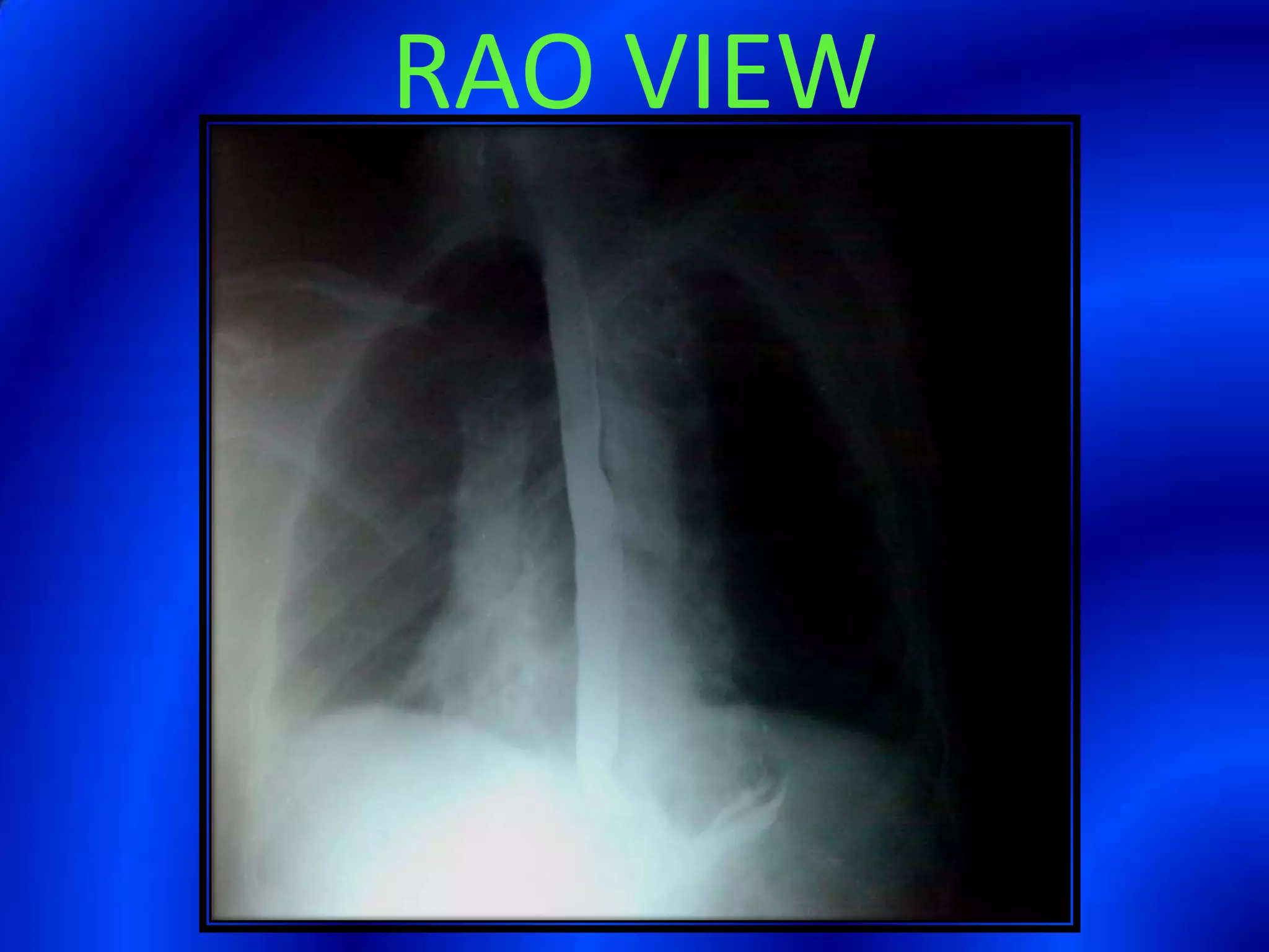 Barium Swallow Presentation | PPTX