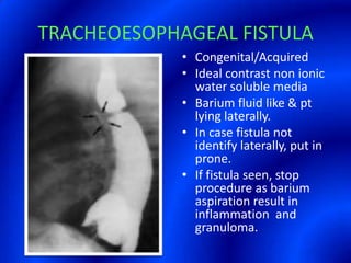 Tracheoesophageal Fistula Barium Swallow