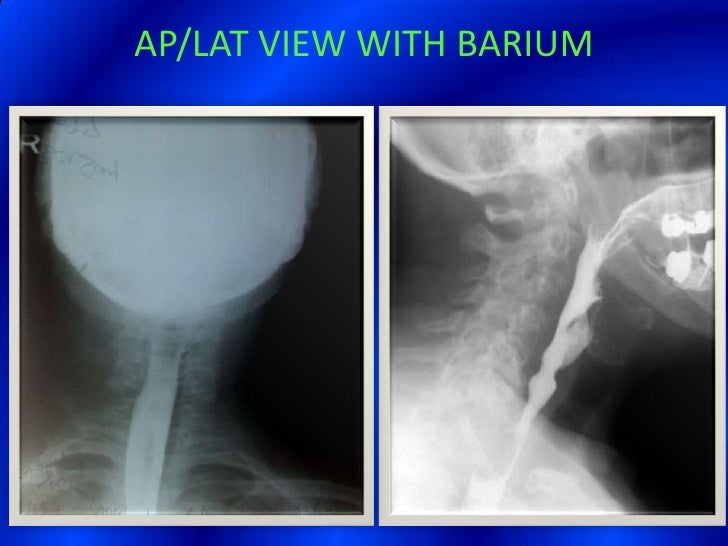 Modified Barium Swallow