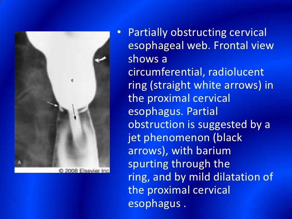 Modified Barium Swallow