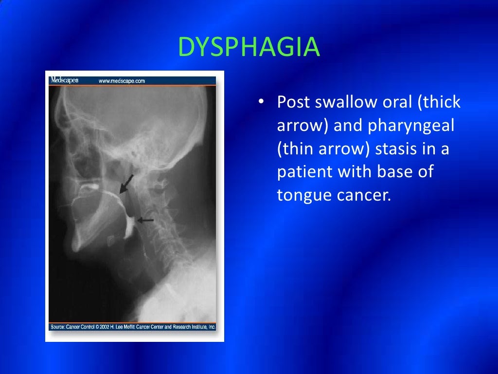 Barium Swallow Presentation