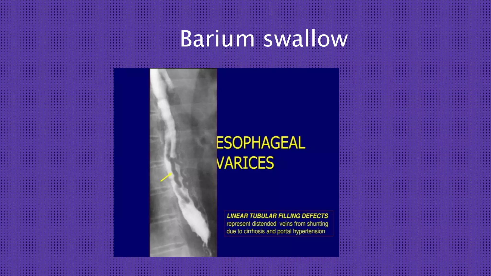 Barium swallow. Srinivas Rao Khorfakkhan hospital | PPTX