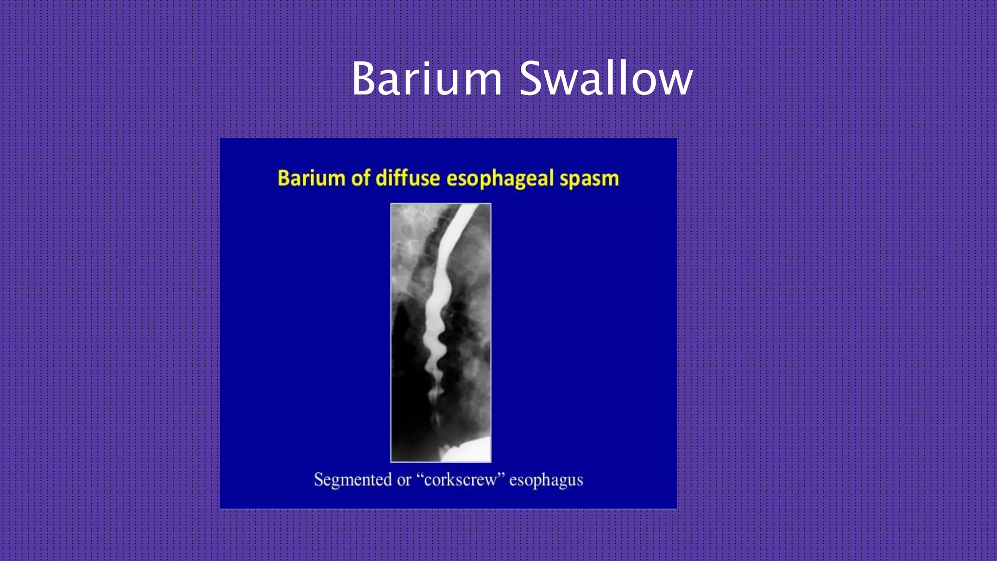 Barium swallow. Srinivas Rao Khorfakkhan hospital | PPTX