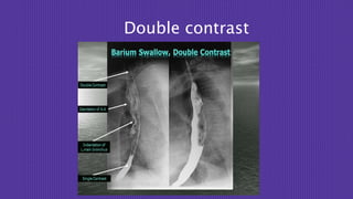 Barium swallow. Srinivas Rao Khorfakkhan hospital | PPTX