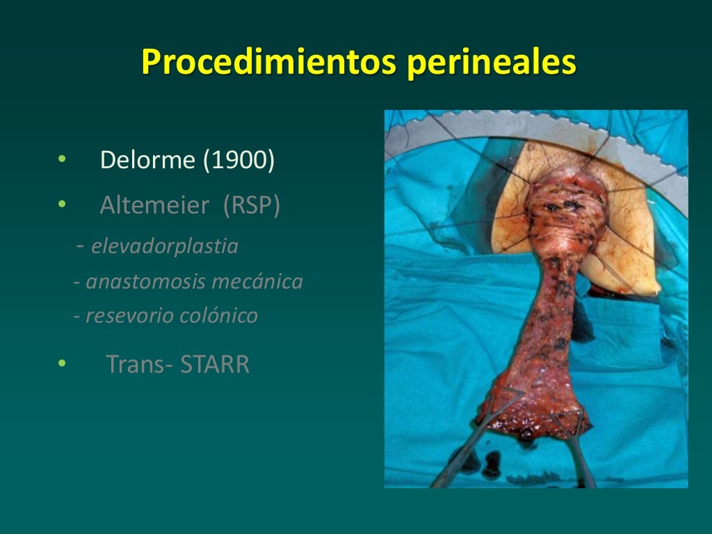 Prolapso rectal: up to date