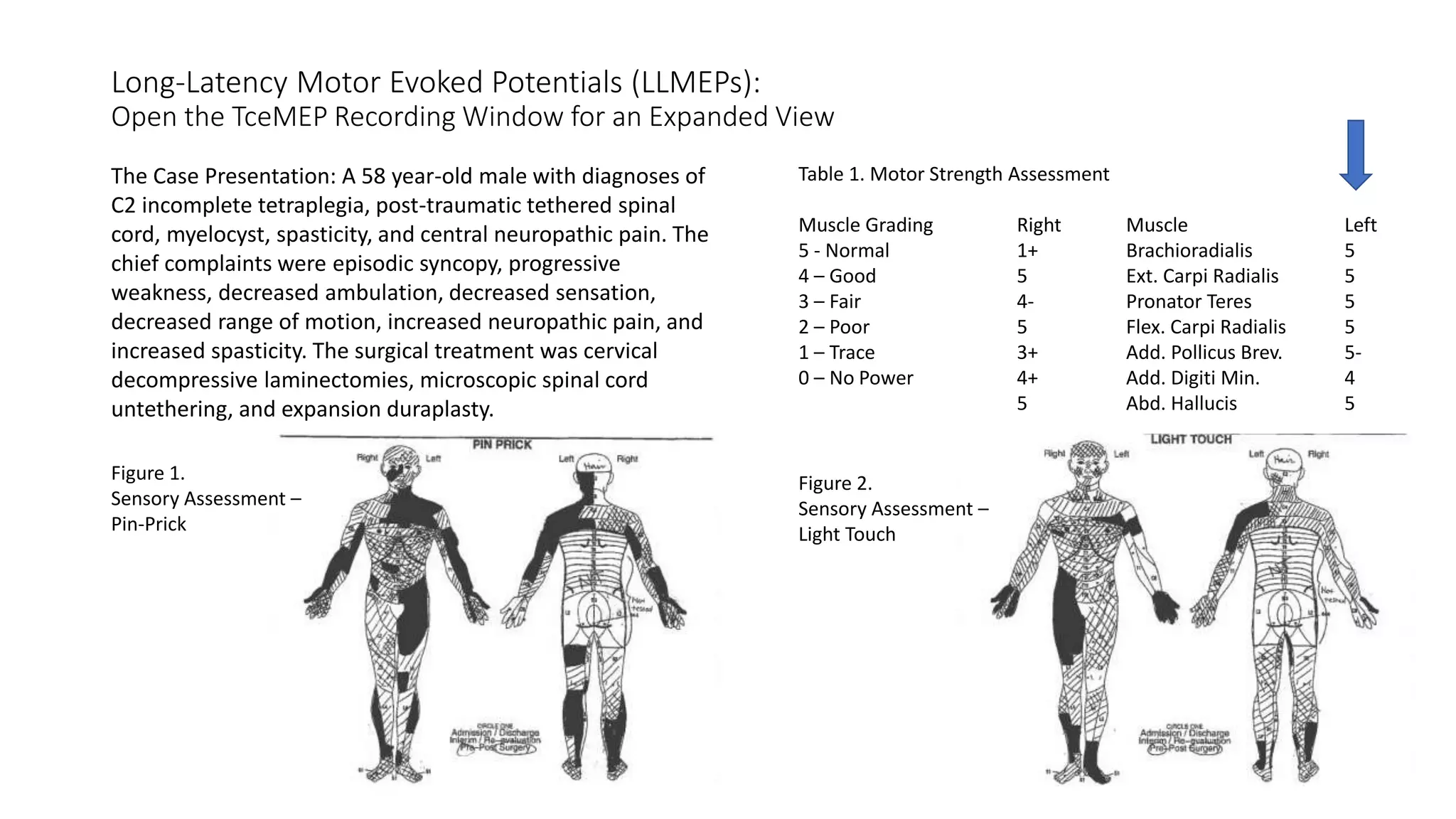 Long-Latency Motor Evoked Potentials (LLMEPs): Open the TceMEP Recording Window for an Expanded ...