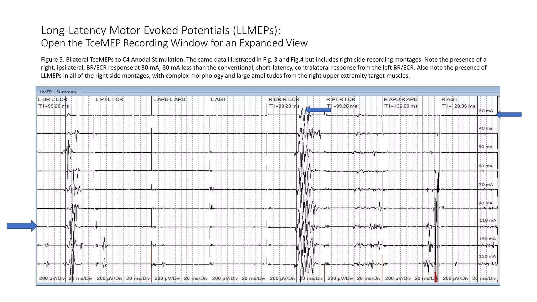 Long-Latency Motor Evoked Potentials (LLMEPs): Open the TceMEP ...