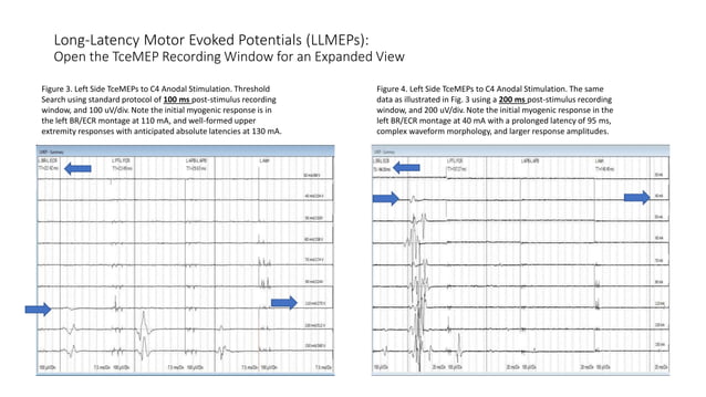 Long-Latency Motor Evoked Potentials (LLMEPs): Open the TceMEP Recording Window for an Expanded ...