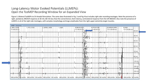 Long-Latency Motor Evoked Potentials (LLMEPs): Open the TceMEP Recording Window for an Expanded ...