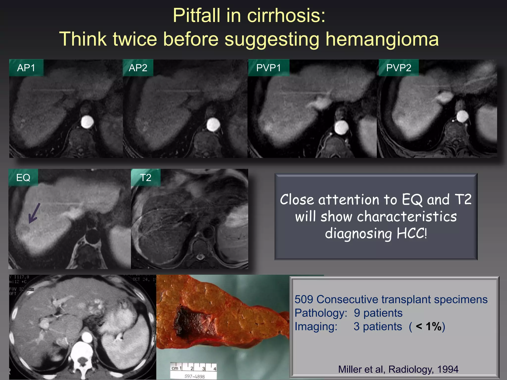 Baron pitfalls in liver imaging cirrhosis_rsna 2014 | PPT | Free Download