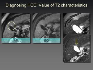 Baron pitfalls in liver imaging cirrhosis_rsna 2014 | PPT